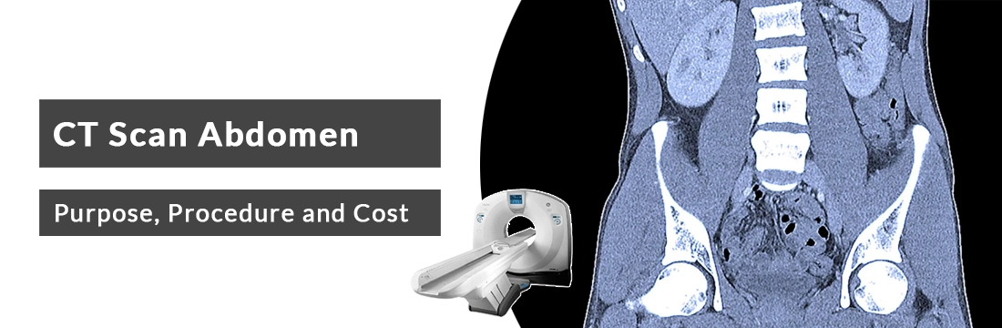 CT Scan Abdomen: Purpose, Procedure, Cost in Delhi/ Noida/ Ncr
