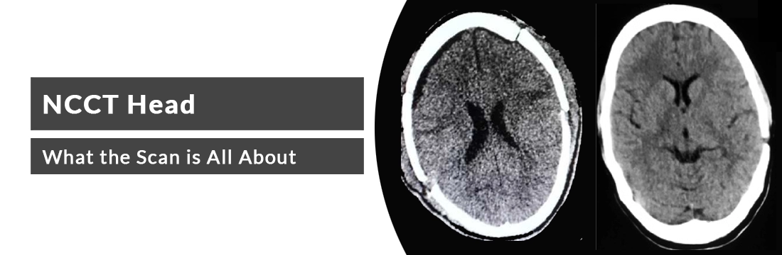 NCCT Head: What the Scan is All About | Ganesh Diagnostic