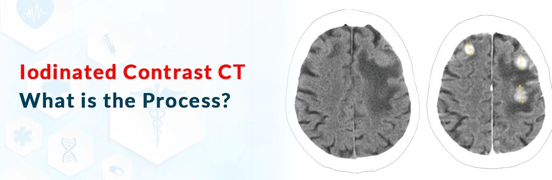 What is the Process of Iodinated Contrast CT Scan | Ganesh Diagnostic