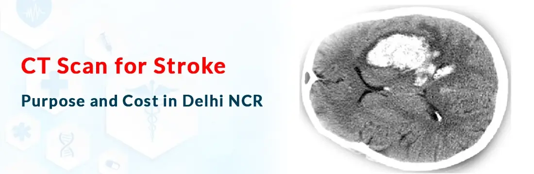 CT Scan for Stroke: Purpose and cost in Delhi | Ganesh Diagnostic