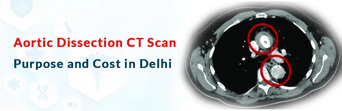 Aortic Dissection CT Scan: Purpose and Cost in Delhi | Ganesh Diagnostic