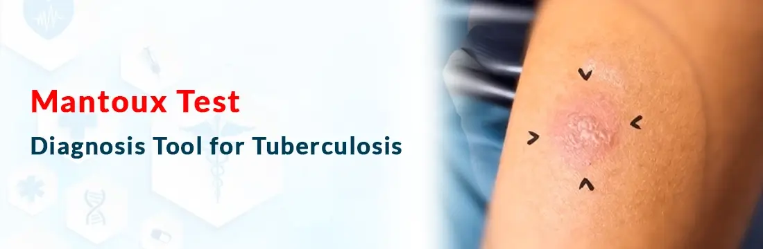 Mantoux Test Diagnosis Tool for Tuberculosis | Ganesh Diagnostic