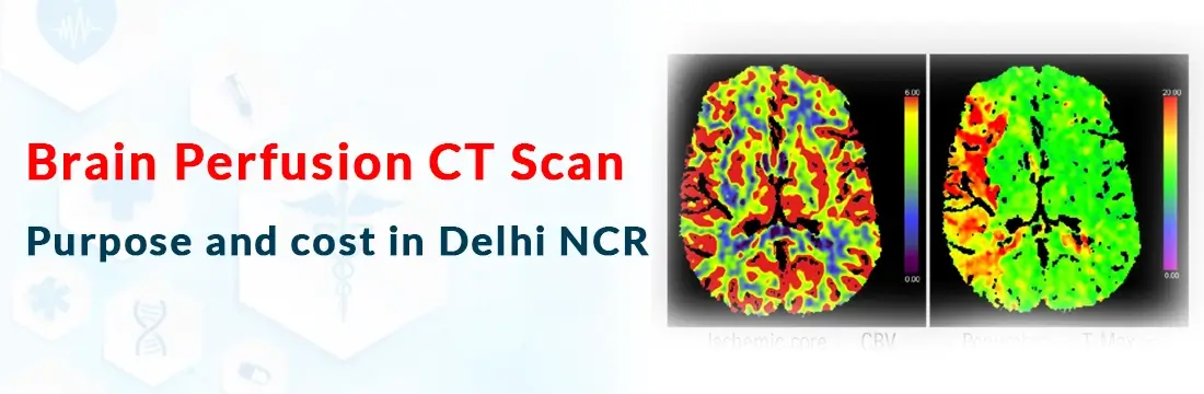 Purpose and Cost of Brain perfusion CT Scan in Delhi NCR