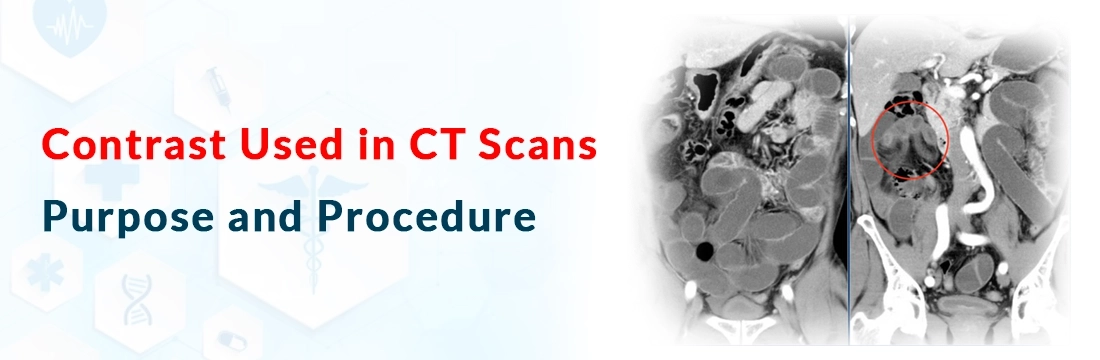 Purpose and Procedure of Contrast Used in CT Scan