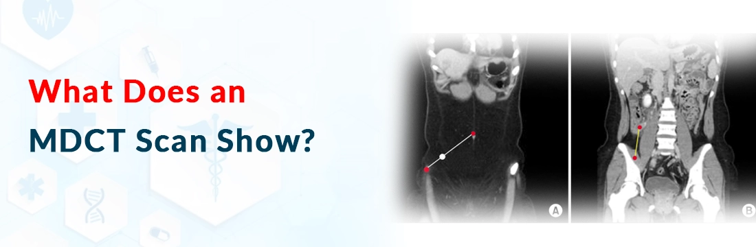 What Does an MDCT Scan Show | Ganesh Diagnostic