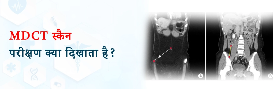 MDCT स्कैन: परीक्षण क्या दिखाता है | What Does an MDCT Scan Test Show ...