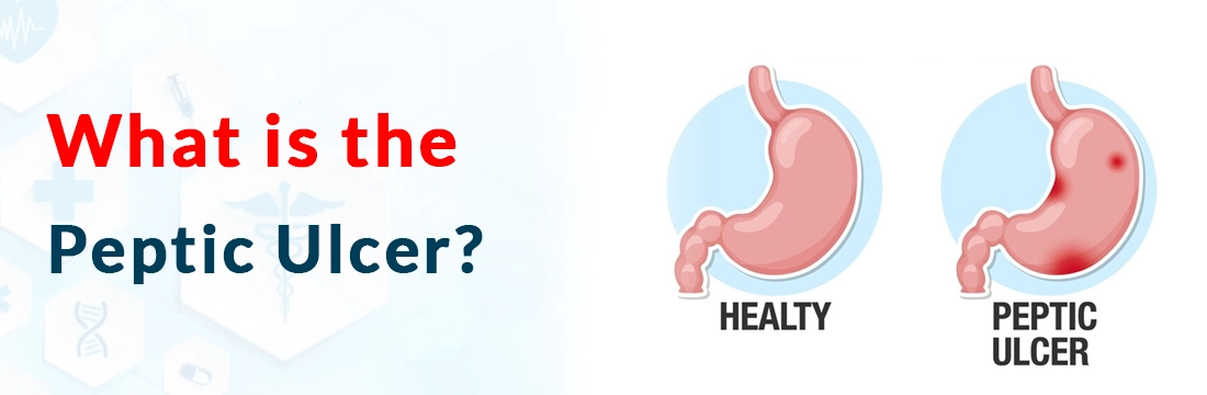 What is the Peptic Ulcer | Ganesh Diagnostic