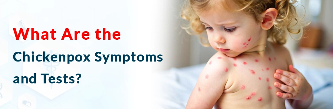 Symptoms of Chickenpox and Its Tests | Ganesh Diagnostic