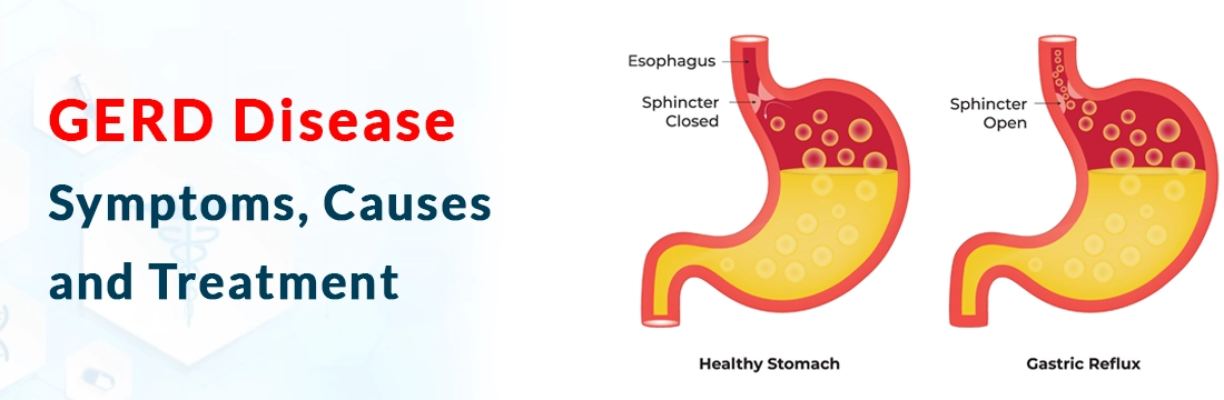 GERD Disease: Symptoms, Causes and Treatment | Ganesh Diagnostic