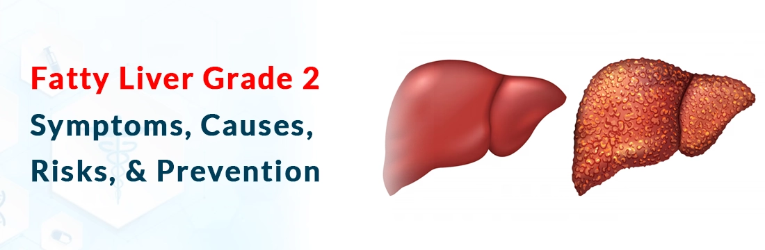Fatty Liver Grade 2: Symptoms, Causes, Risks, & Prevention