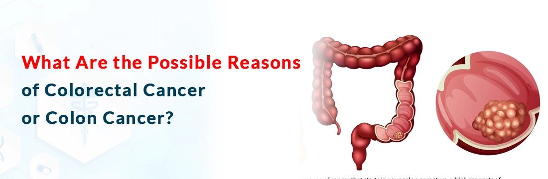 Possible Reasons of Colorectal Cancer or Colon Cancer
