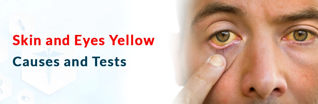 Skin and Eyes Yellow: Causes and Tests | Ganesh Diagnostic