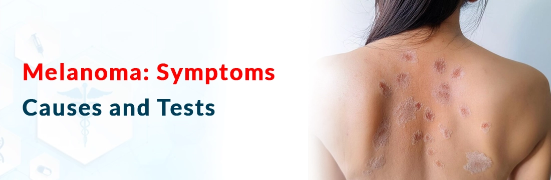 Melanoma: Symptoms, Causes and Tests | Ganesh Diagnostic