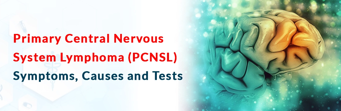 Primary Central Nervous System Lymphoma (PCNSL): Symptoms, Causes and Tests