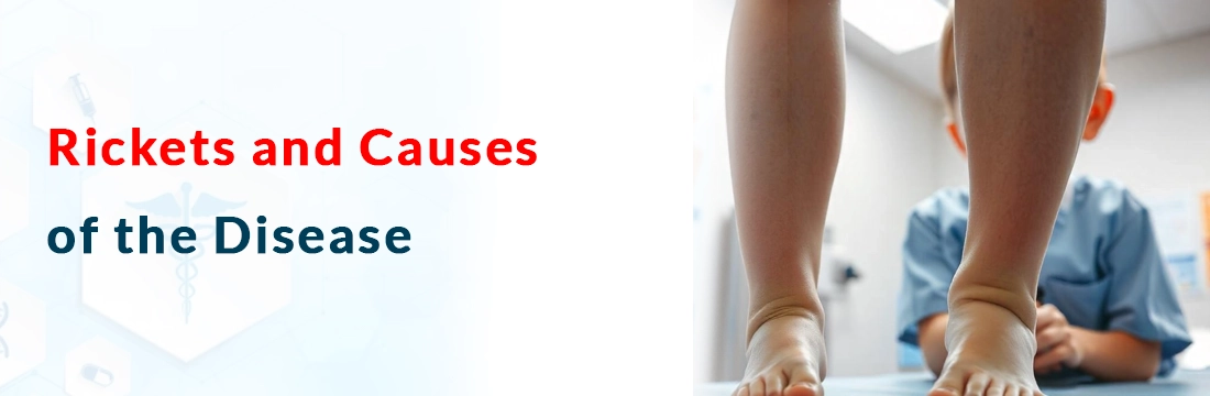 Rickets and Causes of the Disease | Ganesh Diagnostic