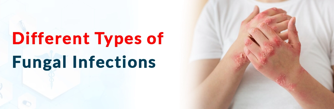 Different Types of Fungal Infections | Fungal Disease
