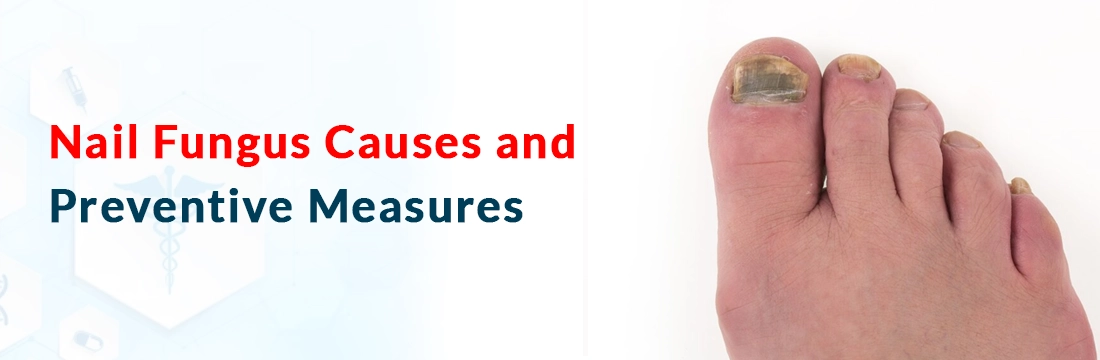 Nail Fungus Causes and Preventive Measures