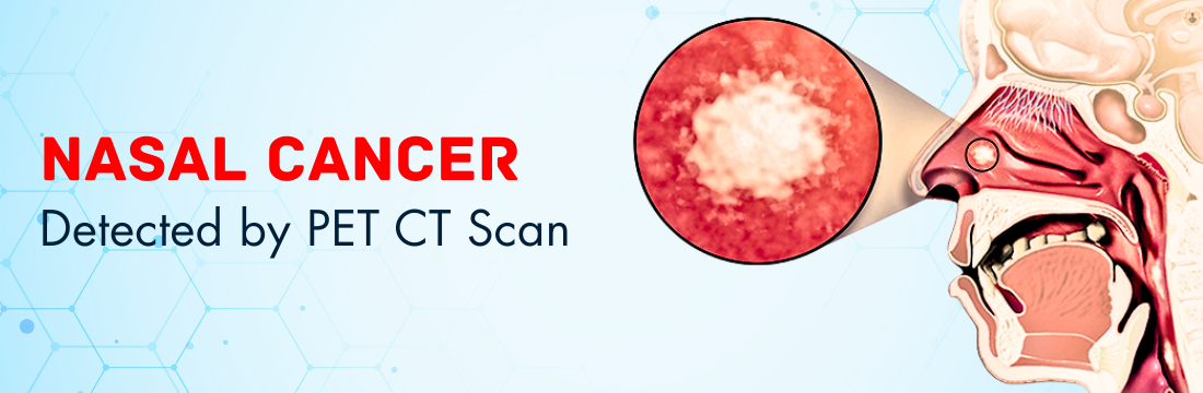 Causes of Nasal Cancer | Ganesh Diagnostic