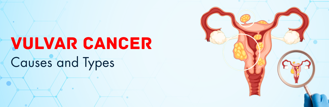 Causes and Types of Vulvar Cancer | Ganesh Diagnostic