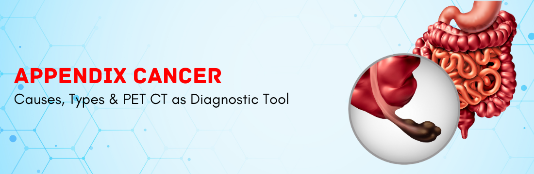 Causes and Types of Appendix Cancer | Ganesh Diagnostic