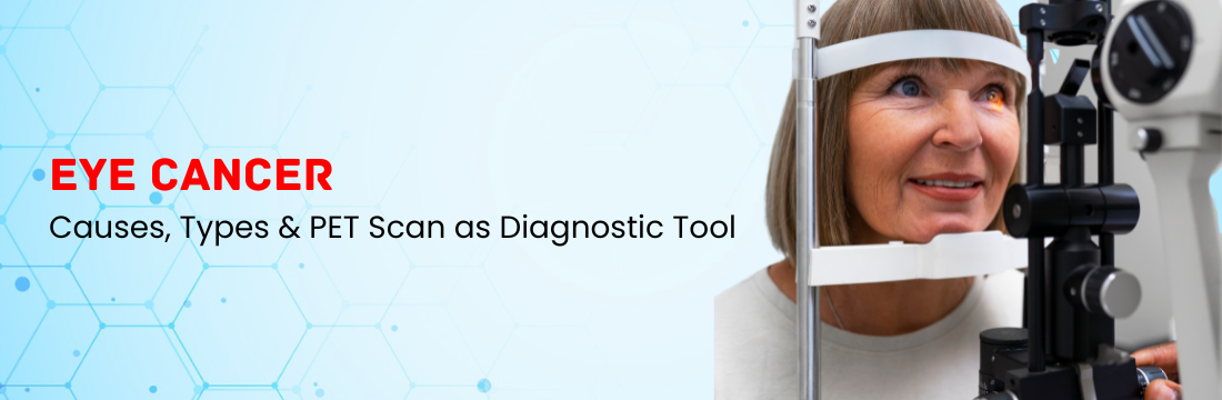 Causes and Types of Eye Cancer | Ganesh Diagnostic
