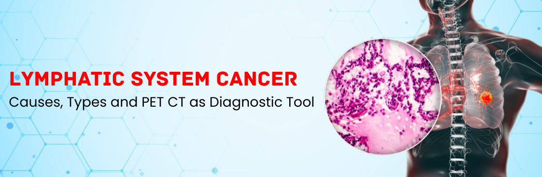 Lymphatic System Cancer: Types and PET CT as Diagnostic Tool