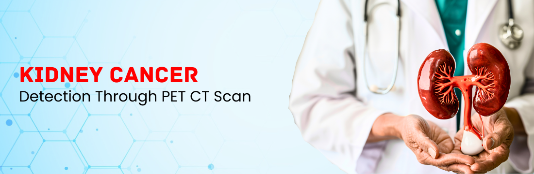 Kidney Cancer Detection Through PET-CT Scan | Ganesh Diagnostic