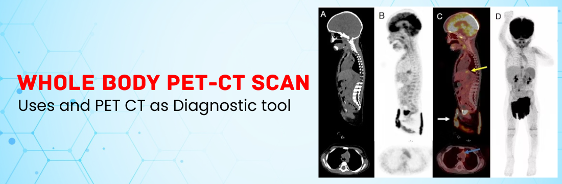When to go for Whole Body PET-CT Scan | Ganesh Diagnstics
