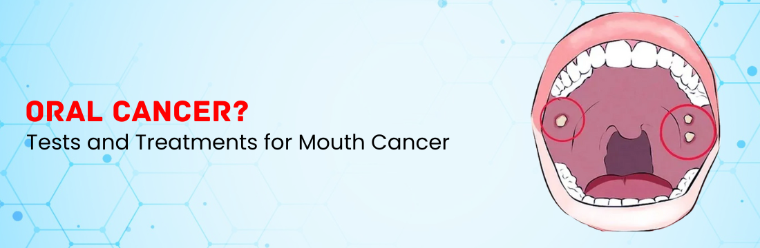 Tests and Treatment for Oral Cancer | Mouth Cancer