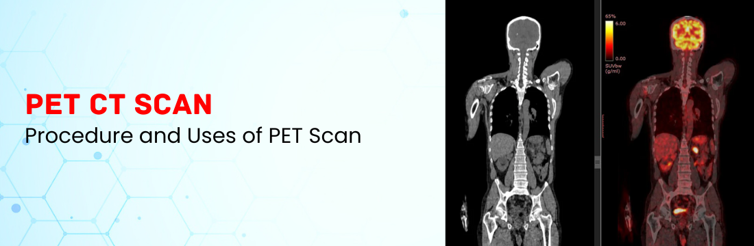 What is the Procedure and Uses of PET-CT Scan? | Ganesh Diagnostic