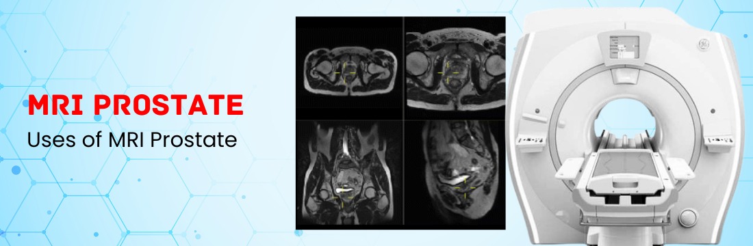 What are the Uses of MRI Prostate | Ganesh Diagnostic