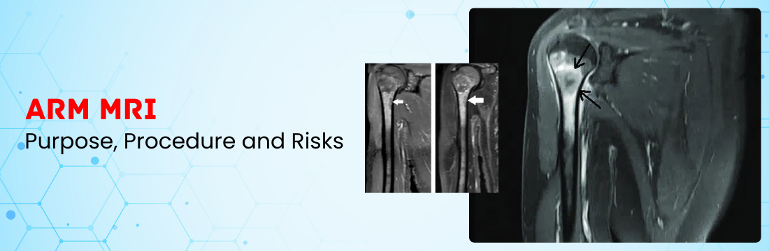 What Are the Purpose of Arm MRI | Ganesh Diagnostic