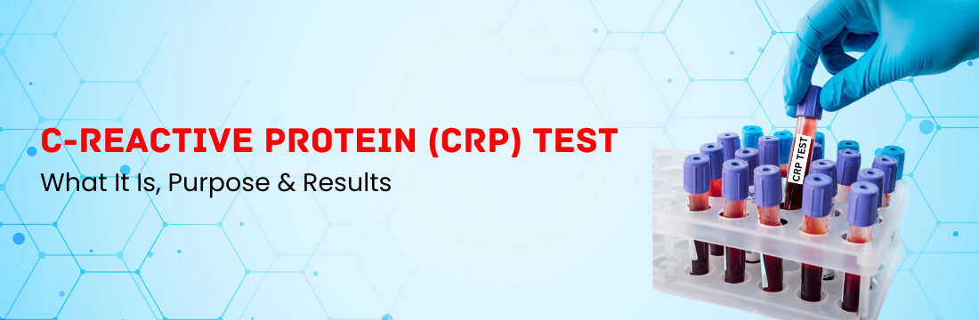 CRP Blood Test: What Is the Purpose, Cost, and Result