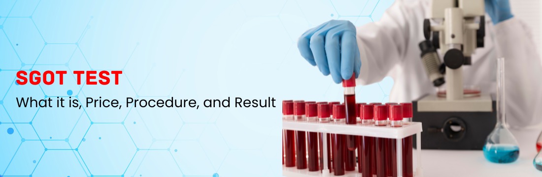 SGOT Test: What it is, Price, Procedure and Result