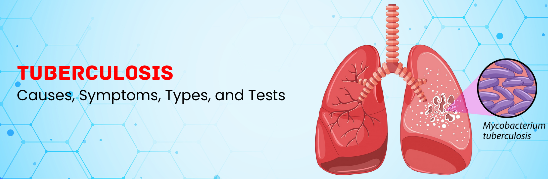 Tuberculosis Explained: Causes, Symptoms, Types, and Tests