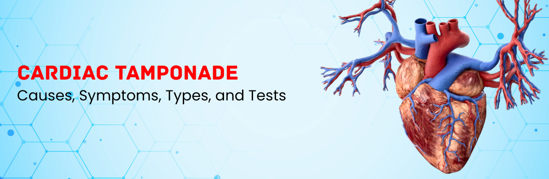 Understanding Cardiac Tamponade: Types, Causes, Symptoms & Tests