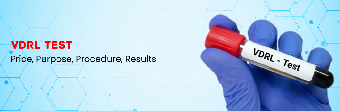 VDRL Test Price: Purpose, Procedure, Results | Ganesh Diagnostic