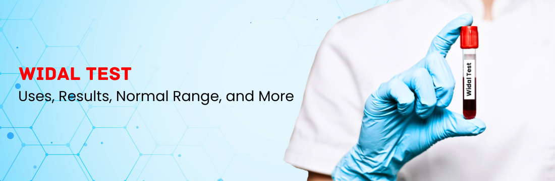 Widal Test - Uses, Results, Normal Range, and More