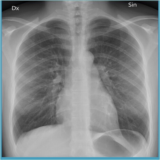 X-Ray Chest PA View | Test Price in Delhi | Ganesh Diagnostic