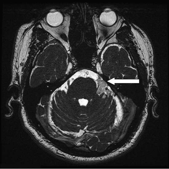Trigeminal Nerve Mri