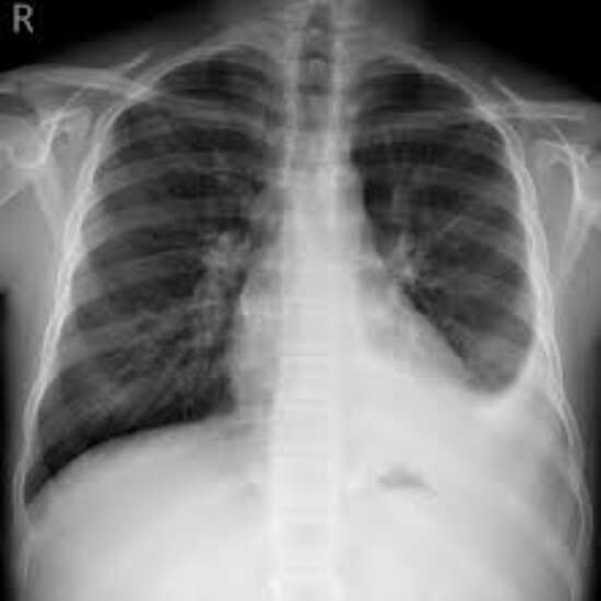 X-ray Chest AP View Near Me | Test Cost Delhi | GDIC