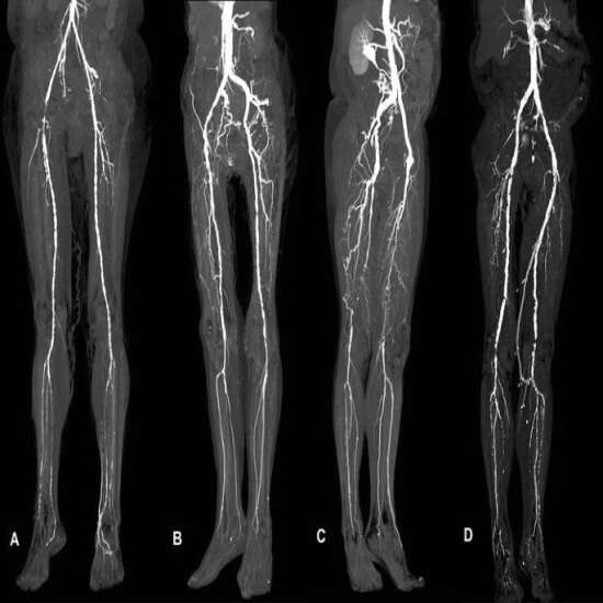 CT Peripheral Angiography | Test Price in Delhi | Ganesh Diagnostic