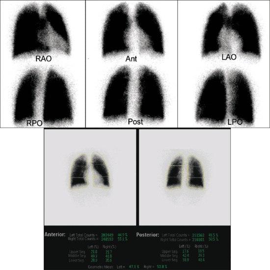What Is A Lung Perfusion Scan at Michelle Bishop blog