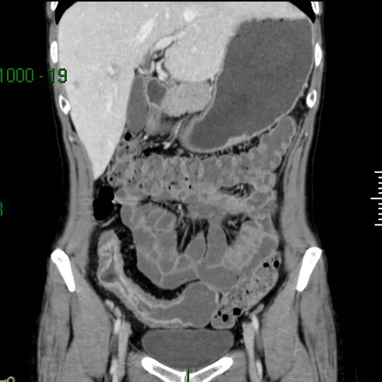 CT Enterography | Test Price in Delhi | Ganesh Diagnostic