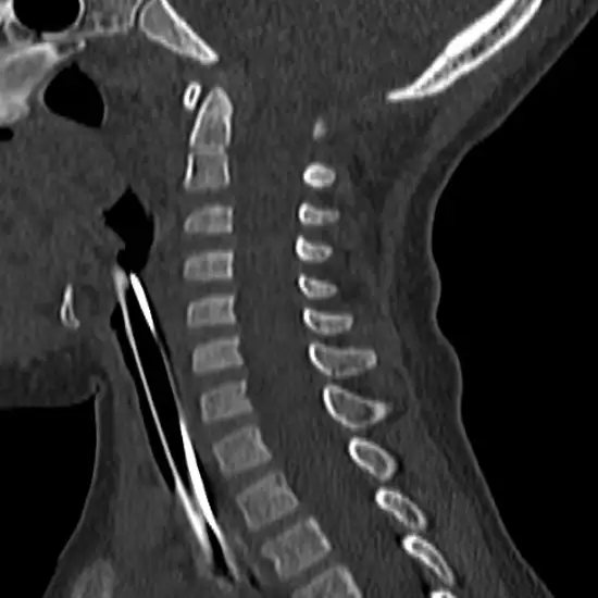 CECT Cervical Spine | Test Price in Delhi | Ganesh Diagnostic