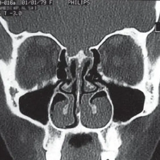 HRCT PNS Coronal | Test Price in Delhi | Ganesh Diagnostic