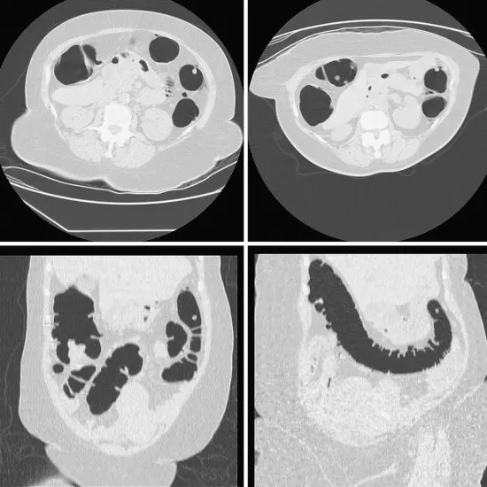 CT Colonography | Test Price in Delhi | Ganesh Diagnostic