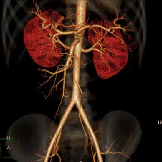 CT Mesenteric Angiography | Test Price in Delhi | Ganesh Diagnostic