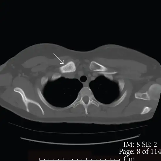 CT Scan Left Clavicle | Test Price in Delhi | Ganesh Diagnostic
