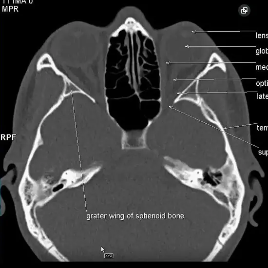 NCCT PNS Axial | Test Price in Delhi | Ganesh Diagnostic